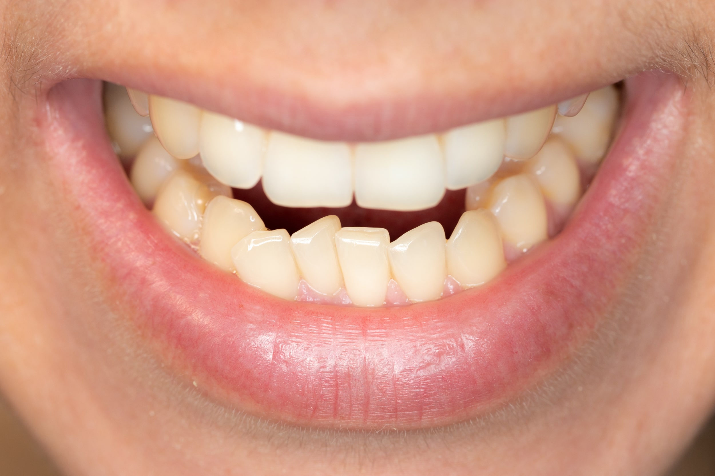 Can Cosmetic Dentistry Correct Crooked Teeth? | High Street